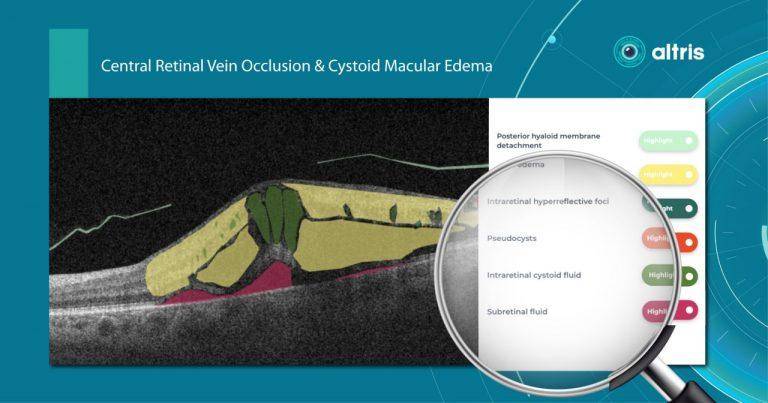 OCT Examination VS Fundus Photography: What to Choose