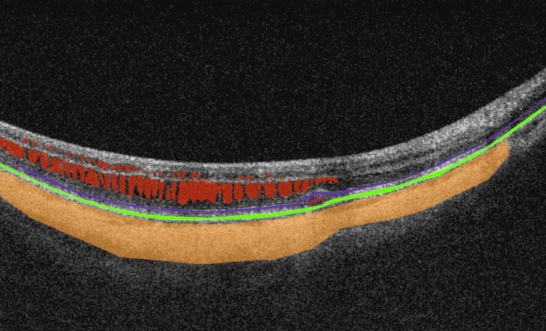 Our Blog – Artificial Intelligence for OCT Interpretation