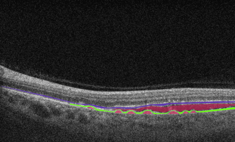 Our Blog – Artificial Intelligence for OCT Interpretation