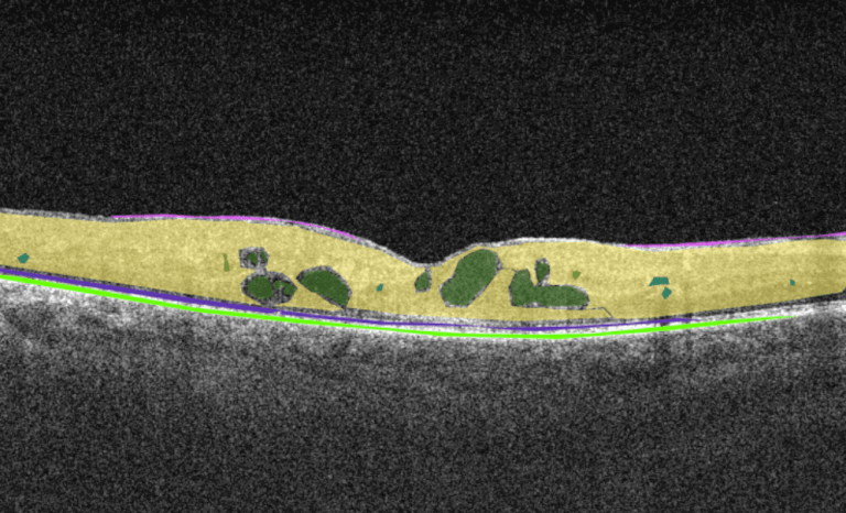 Our Blog – Artificial Intelligence for OCT Interpretation