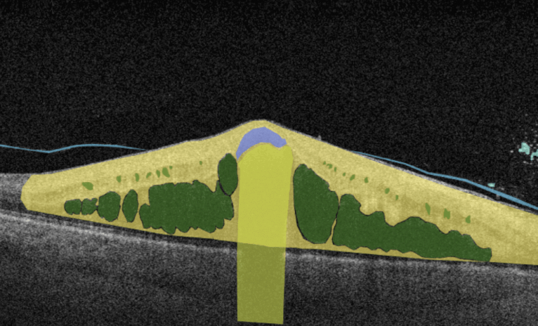 Our Blog – Artificial Intelligence for OCT Interpretation