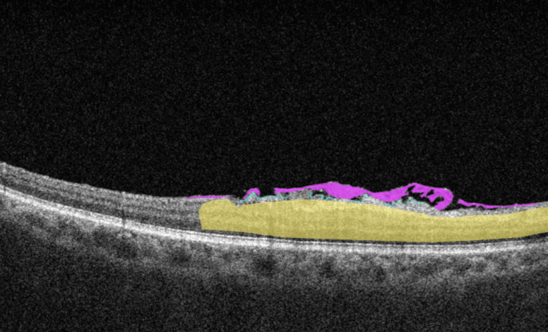Our Blog – Artificial Intelligence for OCT Interpretation