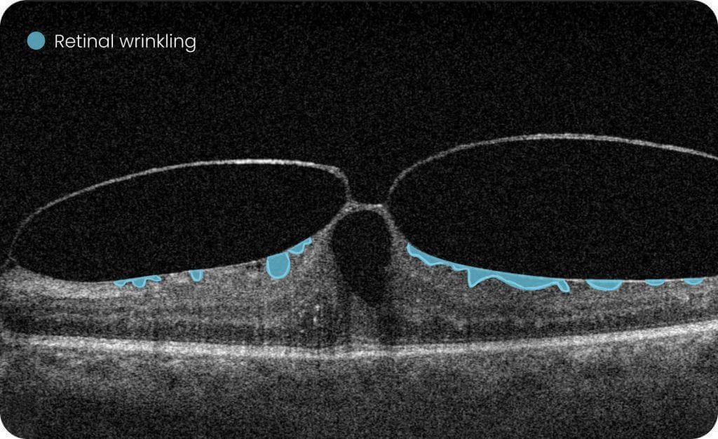 The Application of Machine Learning in Ophthalmology