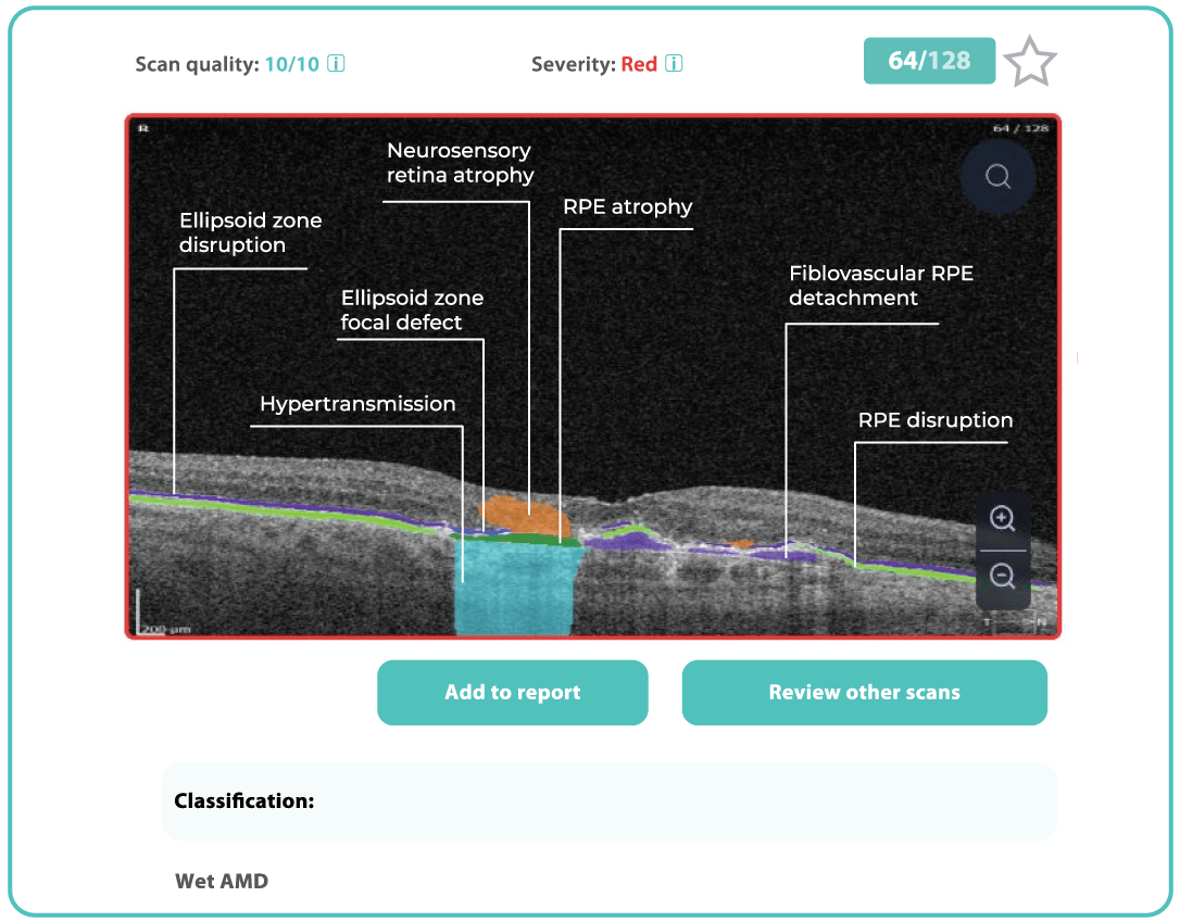 OCT analysis with AI