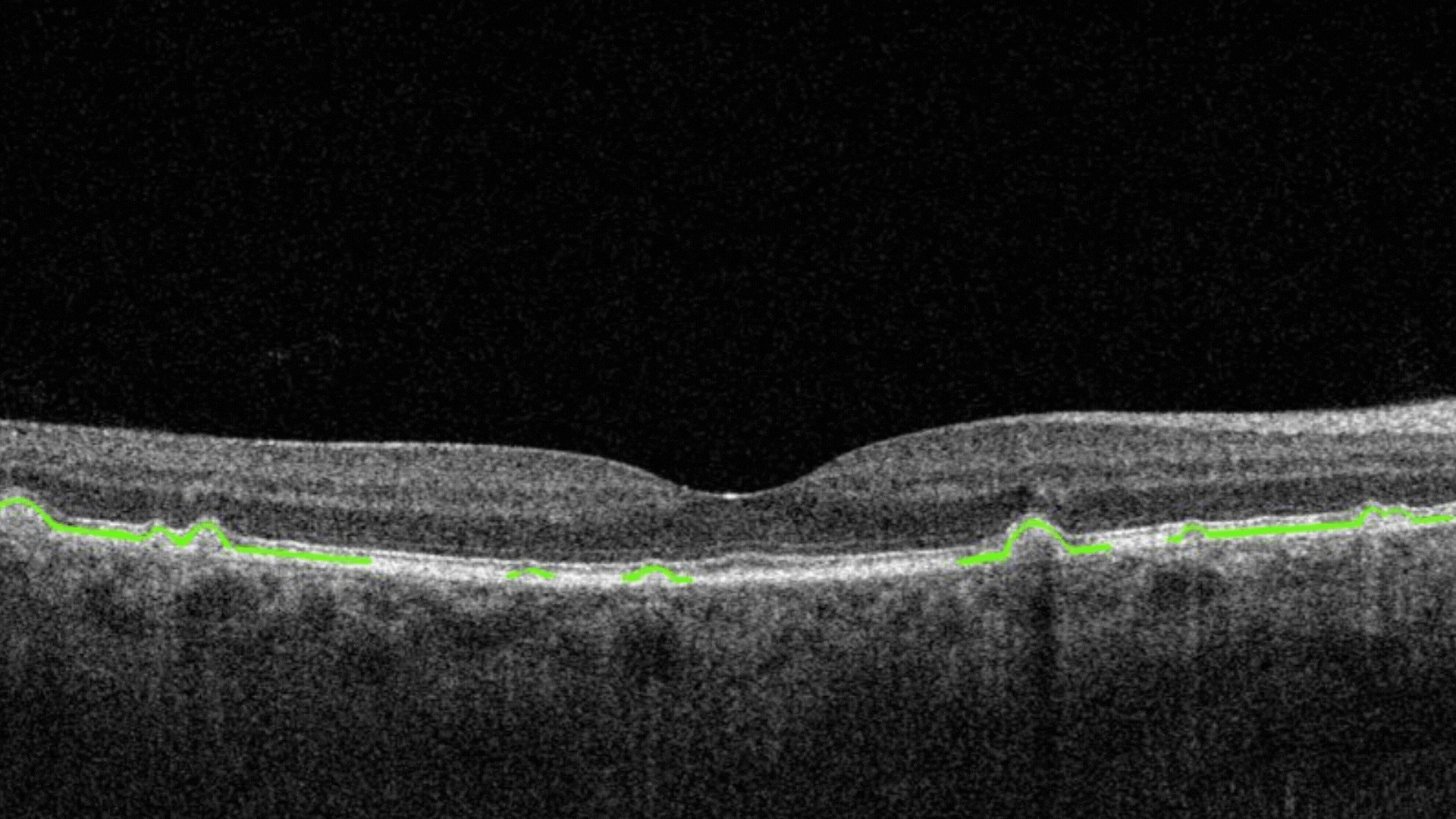 OCT workflow ophthalmology - altris