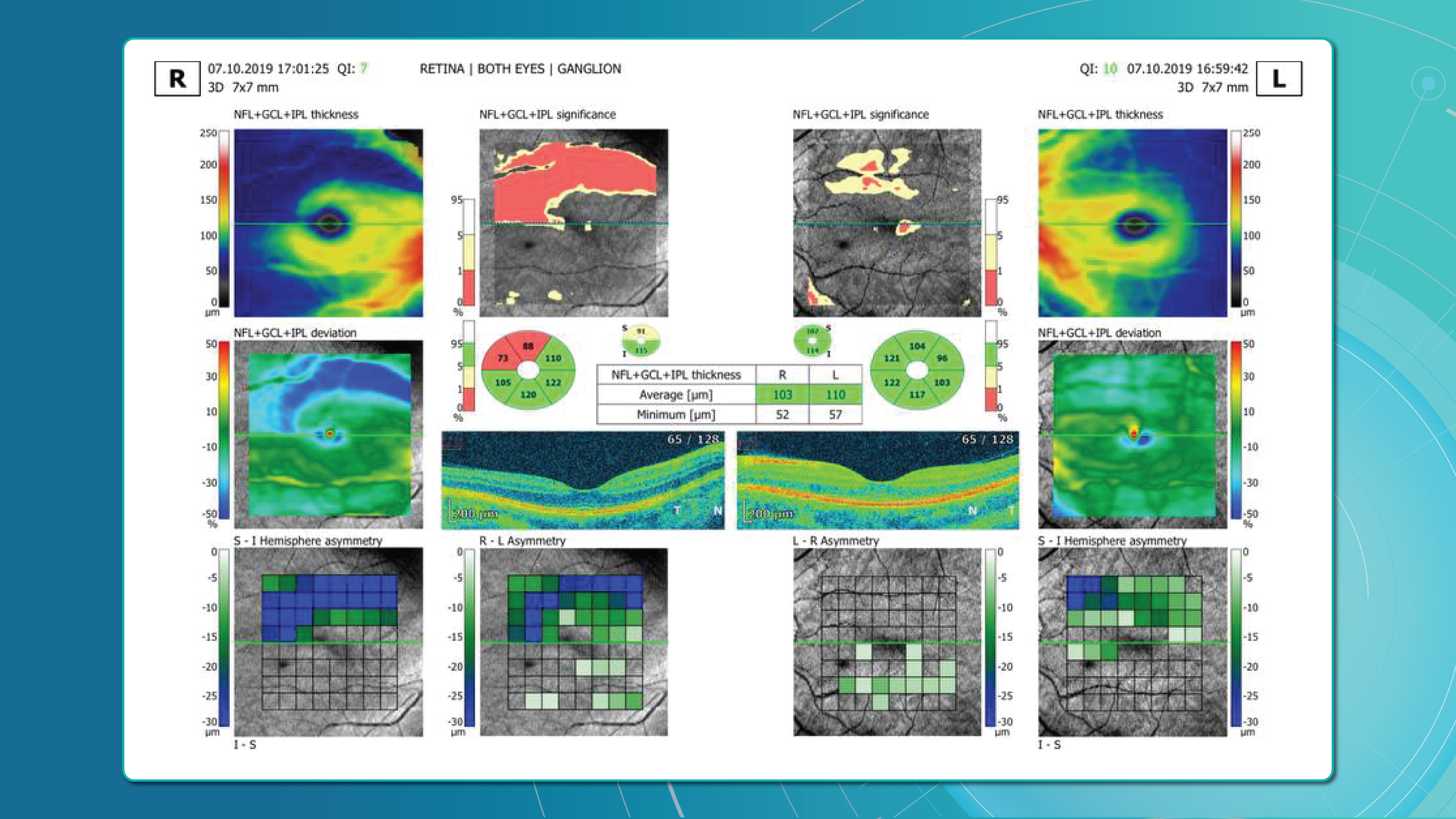 Glaucoma OCT: Early Detection, Progression Monitoring & Treatment Guide