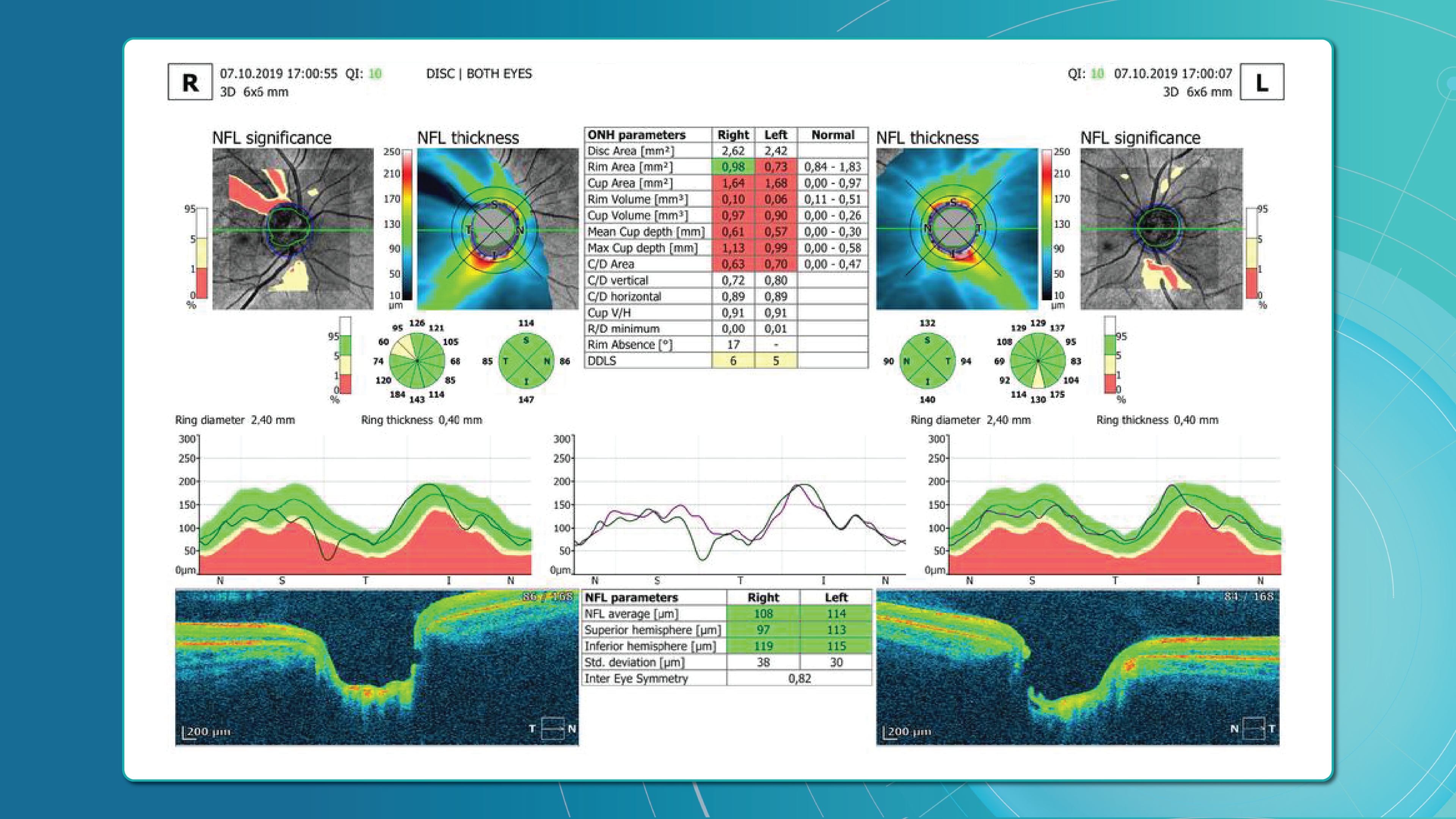Glaucoma OCT: Early Detection, Progression Monitoring & Treatment Guide