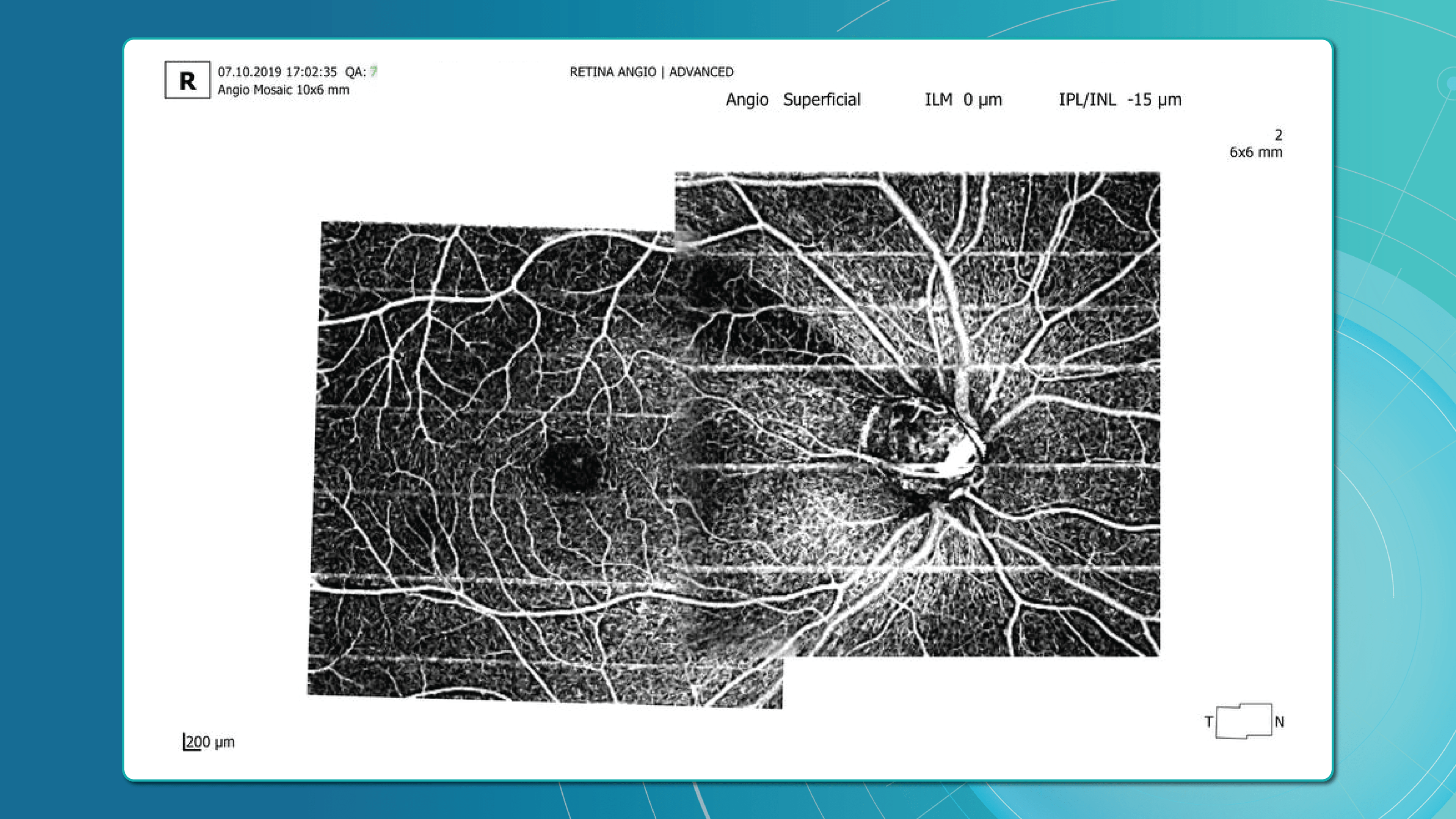 Glaucoma OCT: Early Detection, Progression Monitoring & Treatment Guide